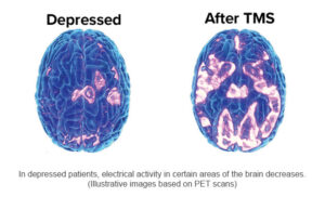 What Is TMS - Transcranial Magnetic Stimulation? | LifeQuality TMS
