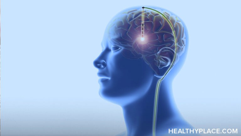 Deep Brain Stimulation Vs Tms Which Is Right For You Lifequality